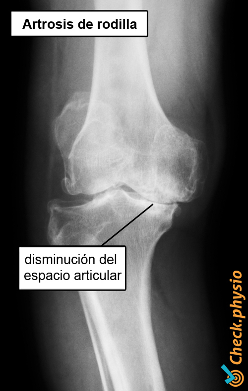 Artrosis de rodilla | Causa, síntomas y tratamiento