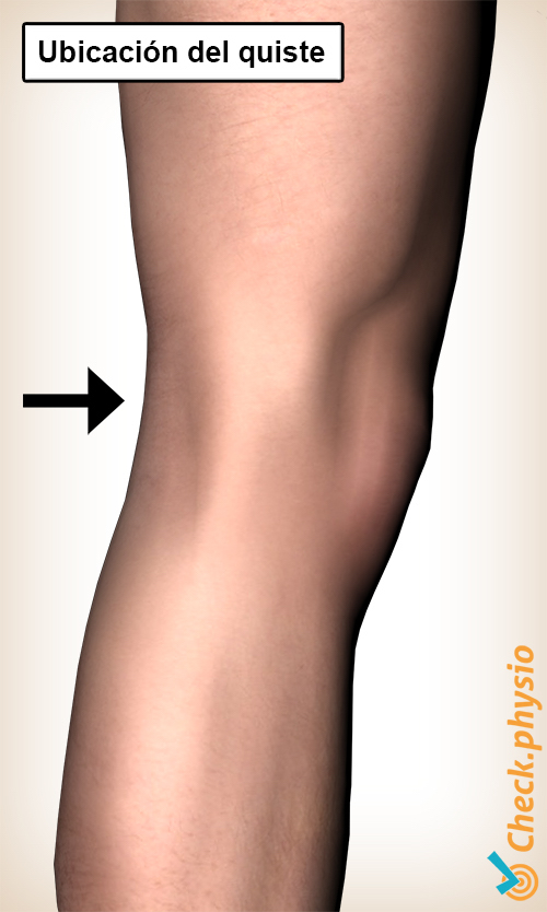 Causa, síntomas y tratamiento | Quiste de Baker - Physiocheck.cl