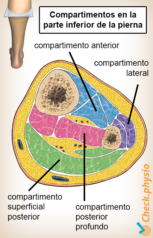 Síndrome compartimental de la pantorrilla