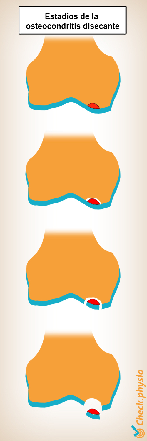 Osteocondritis disecante | Causa, síntomas y tratamiento
